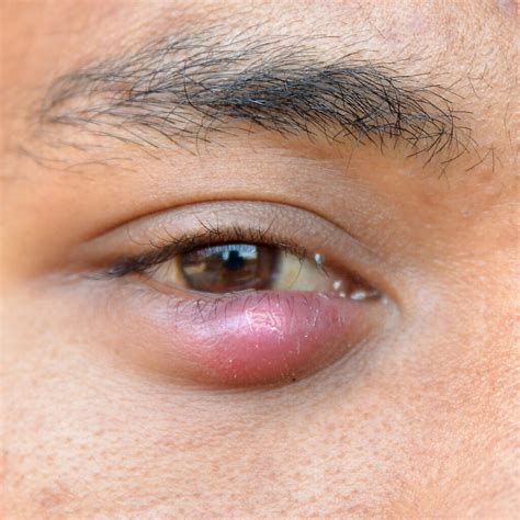 Difference Between A Stye And A Chalazion Causes Symptoms And Treatment