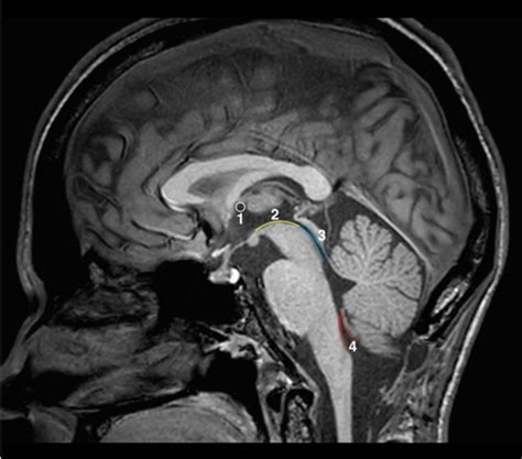 Brain Ct Scans Flashcards Quizlet