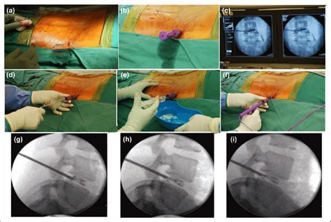 Procedural Steps For Disc Fx A Skin Incision B Cannula In Place Download Scientific
