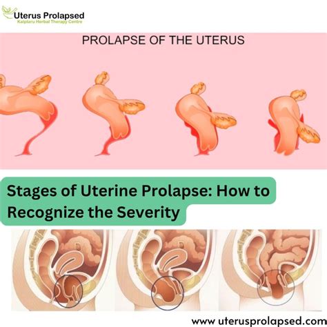 Stages Of Uterine Prolapse How To Recognize The Severity