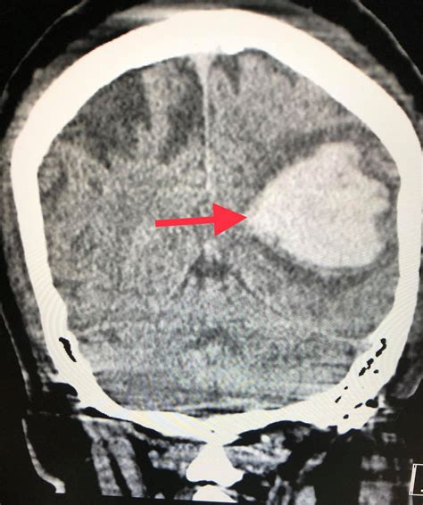 หลอดเลือดแดงในสมองแตกเฉียบพลันทำให้ หมอมนูญ ลีเชวงวงศ์ Fc
