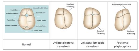 Clinical Practice Guidelines Positional Plagiocephaly