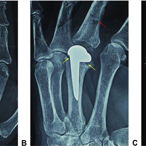 Postoperative Plain Radiographs Following The Second Stage Revision Download Scientific Diagram