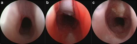 Endoscopic Photos Of A Patient With Congenital Subglottic Stenosis And