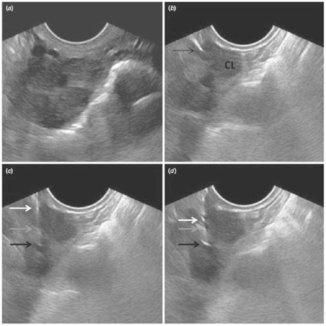The Transvaginal Ultrasound Guided Biopsy A The Ovary Is Pushed Download Scientific Diagram