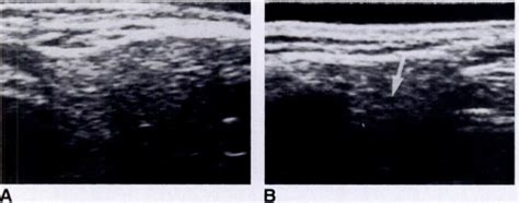 Sonographic Grading Based On Contour And Internal Echoes Of Parotid Download Scientific
