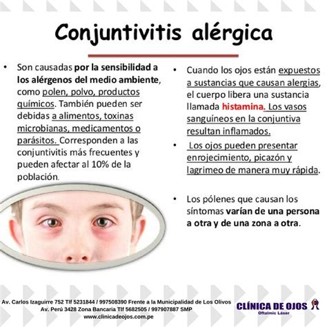 Clínica De Ojos Oftalmic Láser Conjuntivitis AlÉrgica