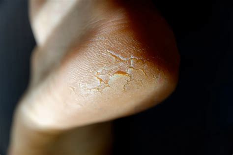 Scaly Skin On Feet