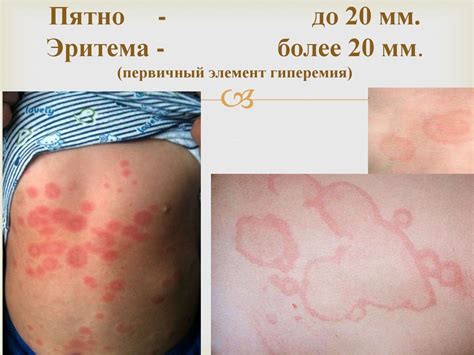 Экзантемы у детей презентация онлайн