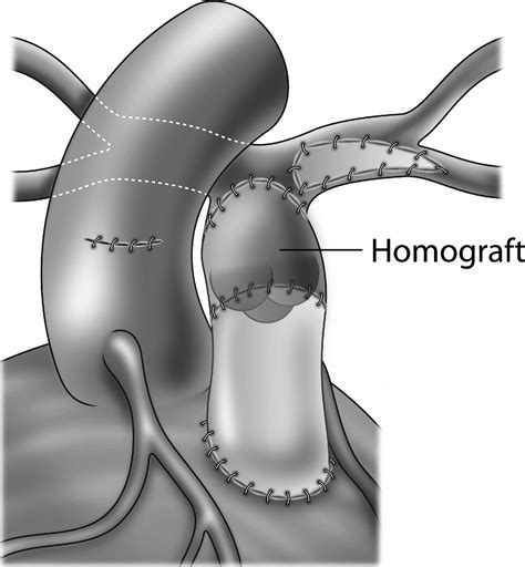 Pulmonary Atresia Vsd And Mapcas Repair Without Unifocalization Seminars In Thoracic Pulmonary Atresia Vsd And Mapcas Repair Without Unifocalization Seminars In Thoracic
