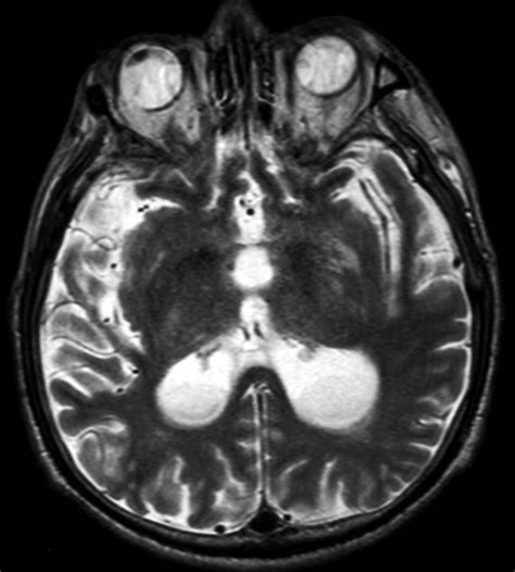 Comparison Of Mri Sequences To Detect Ventriculitis Ajr