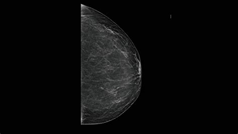 Ai Breast Cancer Imaging Shows Great Promise For Predicting Risk