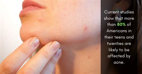 Red Alert Reduce Pimple Swelling In Easy Steps