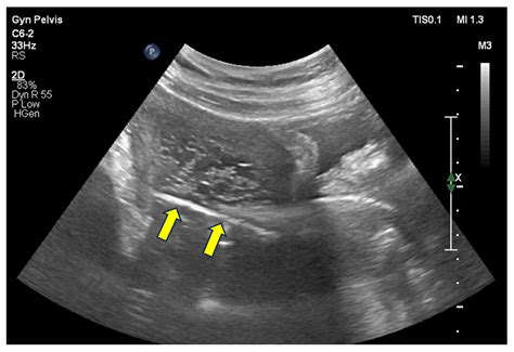 Pathophysiology Of A Molar Pregnancy