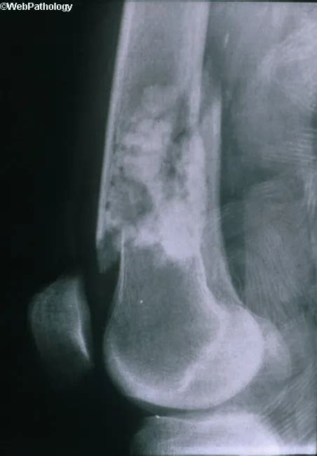 Chondrosarcoma Femur