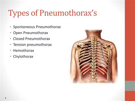 Ppt Spontaneous Pnemothorax Powerpoint Presentation Free Download Id 2088577