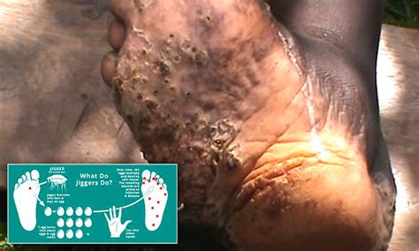 Jigger Flea Bites
