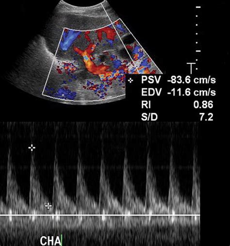 How To Calculate Resistive Index Ultrasound At Jessica Terrill Blog