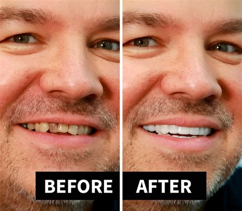 Shiny Smile Veneers Reviews [consumer Reports] Must Read Before Buying