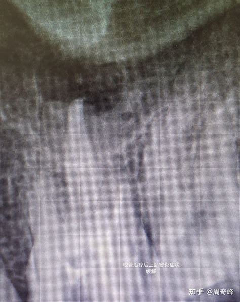 上颌窦炎与蛀牙有关系吗？ 知乎
