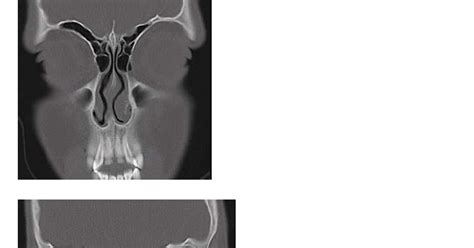 Особенности лучевой диагностики от Александра Шаховского Эталоны краниальной КТ фронтальный срез