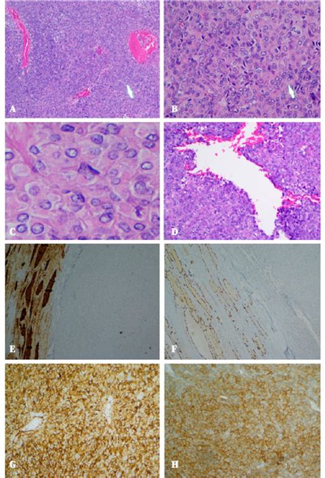 Morphology And Ihc Of The Thyroid Lesion A B C D E F G H A Loss Of