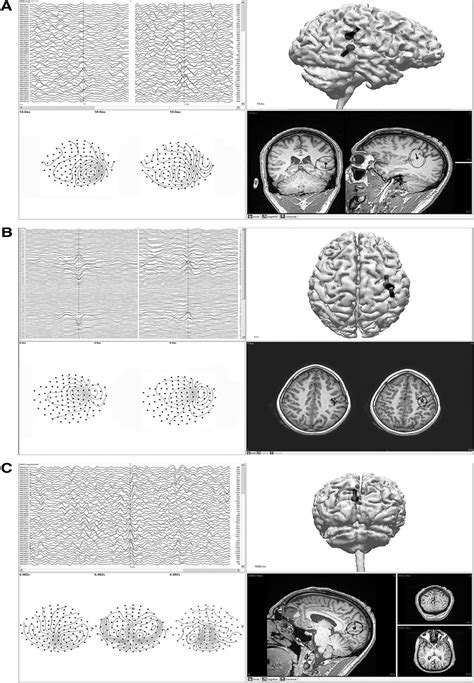 Relative Yield Of Meg And Eeg Spikes In Simultaneous Recordi