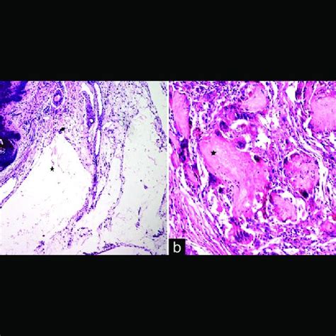 Pdf Bullous Pilomatricoma A Stage In Transition To Secondary Anetoderma Pdf Bullous Pilomatricoma A Stage In Transition To Secondary Anetoderma