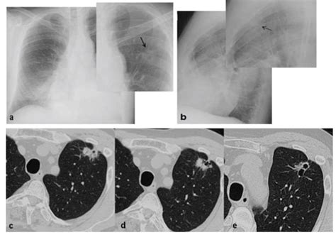 Optune Lua Mesothelioma