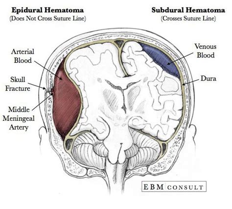 Epidural Hematoma Vs Subdural Hematoma Medizzy