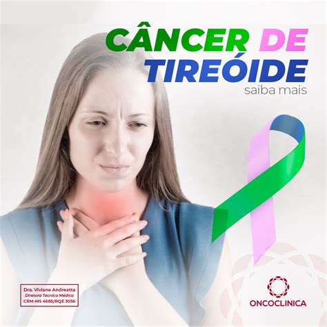 Câncer De Tireoide Oncoclínica Dourados Ms