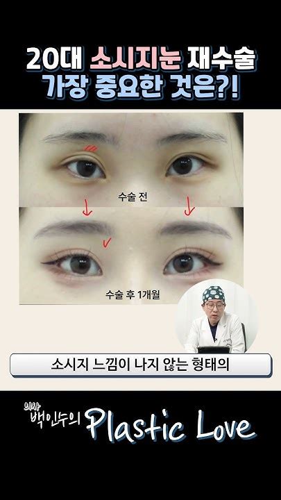 [눈재수술] 후 충격적인😱 인상 변화 Feat 사나운 눈 Youtube