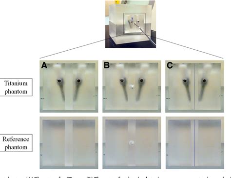 Figure 1 From The Effect Of Metallic Implants On Radiation Therapy In Spinal Tumor Patients With