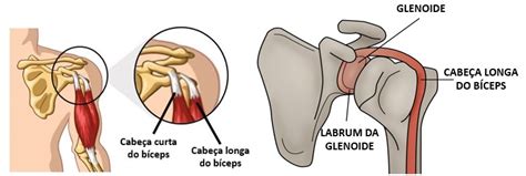 Tendinite Do Bíceps Medicina De Excelência Ortopedista