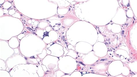 Well Differentiated Liposarcoma Icd 10 Lwdwo