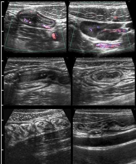 Intestinal Ultrasound Victoria — Bowel Health Scan Melbourne Victoria