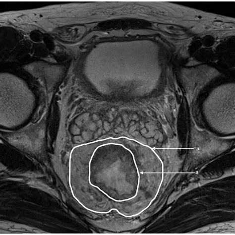 Morphologic Assessment Of Mesorectal Fat Thickness At Different Levels Download Scientific