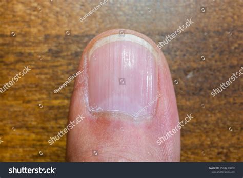 What Do Raised Vertical Lines On Fingernails Mean At Kim Spruill Blog