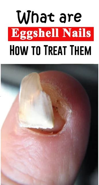 What Are Eggshell Nails How To Treat Them Healthy Lifestyle