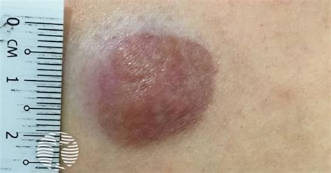 Dermatofibroscarcoma Protuberans Image