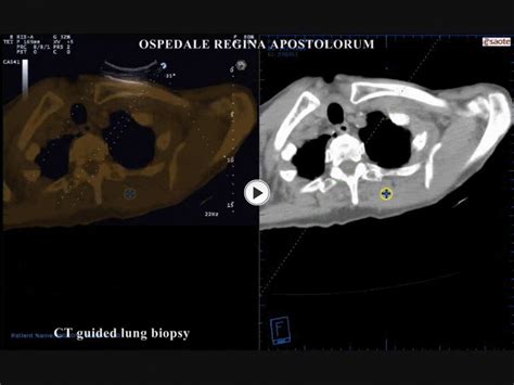 After A Short Z Axis Ct Scan Was Performed In The Area Of Interest Download Scientific Diagram