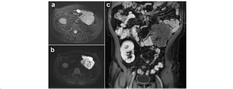 Magnetic Resonance Imaging Scans Of The Gastrointestinal Stromal Tumor Download Scientific