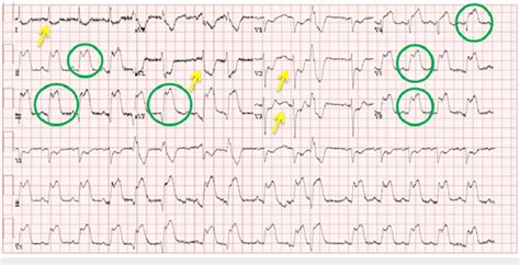 Admission Electrocardiogram Showing New St Segment Elevation Circle Download Scientific