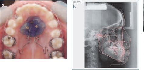 Figure 4 From Orthodontic Decompensation In Class Iii Patients By Means Of Distalization Of
