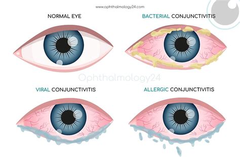 Conjunctivitis Pink Eye