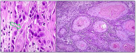 Cancer Grading And Staging Flashcards Quizlet