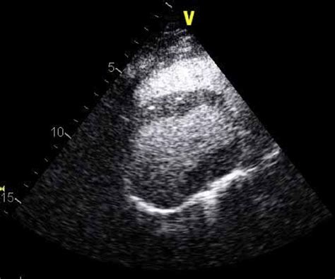 Parasternal Short Axis View In A Contrast Enhanced 2 Dimensional