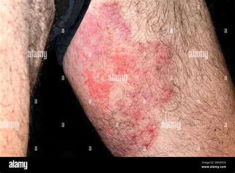 Tinea On The Leg Of A 68 Year Old Female Patient Also Known As