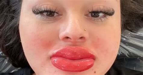 Woman Belongs On Monsters Inc As Lips Balloon After Procedure
