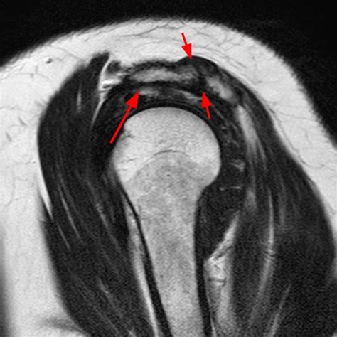 Acromial Stress Fractures After Shoulder Decompression Surgery Radsource